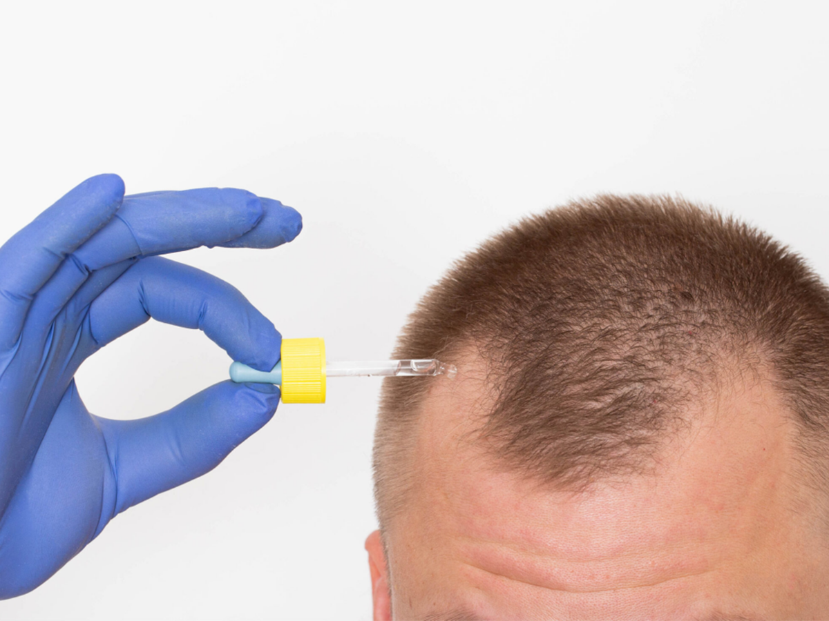 Minoxidil 2% vs 5%: Key Differences, Effectiveness, and Side Effects ...